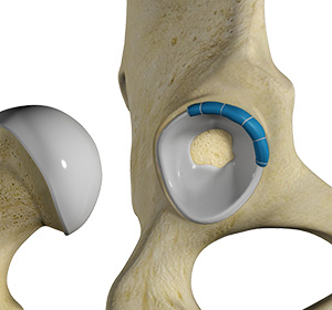 Hip Labral Reconstruction Conway SC | Hip Labral Repair Horry County ...