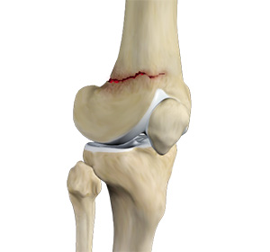 Knee Fracture Treatment Conway SC | Knee Injuries Myrtle Beach, Knee ...