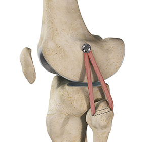 LCL Reconstruction Surgery Conway SC | LCL Injury Horry County, Myrtle ...