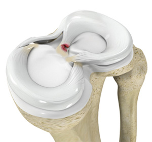 Meniscal Injuries Treatment Conway SC | Meniscal Tears Horry County ...