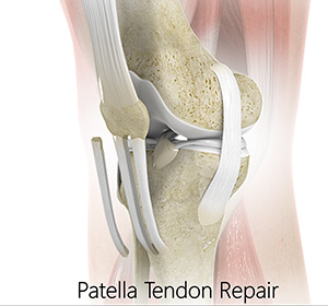 Patellar Tendon Repair Conway SC | Patellar Tendon Tear Horry County ...