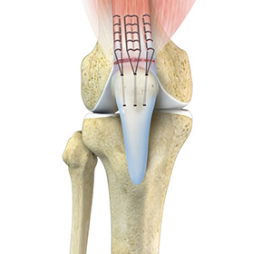 Quadriceps Tendon Repair Conway SC | Quadriceps Tendon Rupture Horry ...
