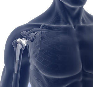 Reverse Shoulder Replacement Conway SC | Severe Shoulder Pain Horry ...