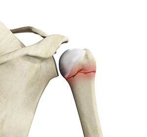Shoulder Fracture Conway | Shoulder Injuries Horry County | Shoulder ...