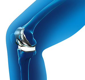 Total Knee Replacement Conway SC | Knee Injury Horry County | Knee ...