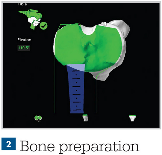Mako Robotic-Arm Assisted Technology for Total Knee Replacement ...