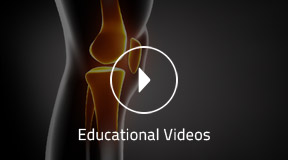 Medial Patellofemoral Ligament Tears Greensboro | Medial Patellofemoral ...