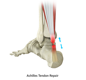 Achilles Tendon Repair Ronceverte, WV | Sports Surgeon Lewisburg, WV
