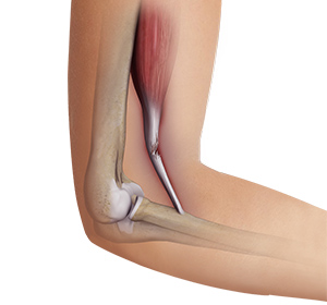 Bicep Tendon Tear Ronceverte, WV | Bicep Tendon Repair Lewisburg, WV