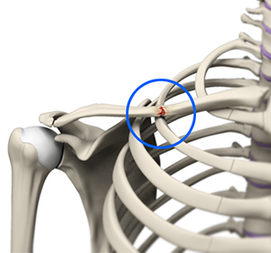 Clavicle Fracture Ronceverte, WV | Shoulder Fixation Surgery in ...