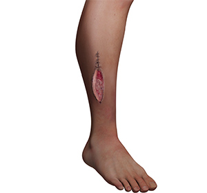 Compartment Decompression Lewisburg, WV | Decompressive Fasciotomy ...