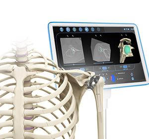 Computer Navigation For Shoulder Replacement Lewisburg, WV | Shoulder ...
