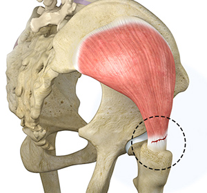 Gluteus Tendon Tear Lewisburg, WV | Gluteus Tendon Repair Ronceverte, WV