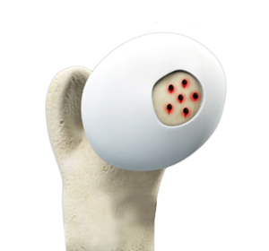 Hip Microfracture Ronceverte, WV | Cartilage Injury Lewisburg, WV