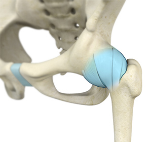 Ischiofemoral Impingement Lewisburg, WV | Buttock Pain Ronceverte, WV