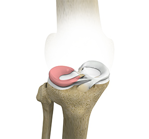 Lateral Meniscus Syndrome Ronceverte, WV | Sports Surgeon West Virginia