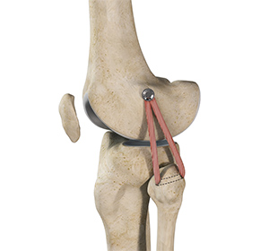 LCL Reconstruction Ronceverte, WV | LCL Tear Lewisburg, WV