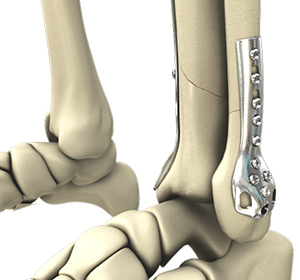 Leg Fracture Lewisburg, WV | Sports Injury Ronceverte, WV