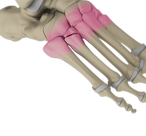 Lisfranc Midfoot Fracture Ronceverte, WV | Sports Medicine Specialist ...