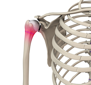 Little League Shoulder Lewisburg, WV | Shoulder Care Center Ronceverte, WV