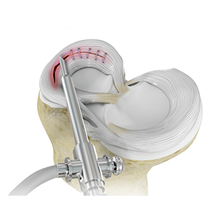 Meniscal Repair Lewisburg, WV | Meniscal Tear Ronceverte, WV