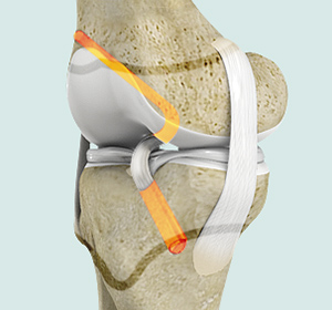 Pediatric ACL Tears Lewisburg, WV | Pediatric Surgeon Ronceverte, WV