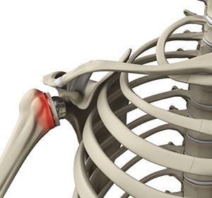 Periprosthetic Shoulder Fixation Lewisburg, WV | Rheumatoid Arthritis ...