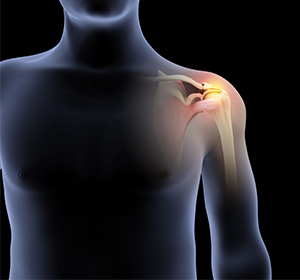 Rotator Cuff Repair Lewisburg, WV | Rotator Cuff Tear Ronceverte, WV