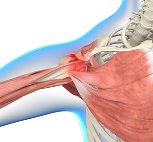 Shoulder Impingement Lewisburg, WV | Physical Therapy Ronceverte, West ...