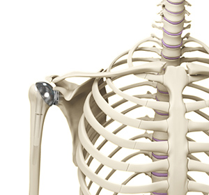 Shoulder Joint Replacement | Erik Stapleton D.O., M.S., Board Certified ...
