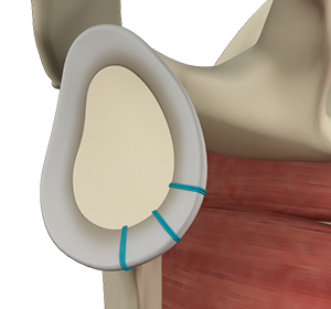Shoulder Stabilization Lewisburg, WV | Shoulder Instability Ronceverte, WV