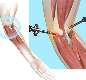 Tennis Elbow Surgery Lewisburg, WV | Tennis Elbow Ronceverte, West Virginia