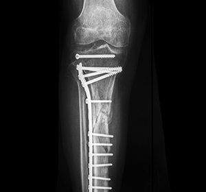 Traumatic Limb Salvage Lewisburg, WV | Limb Sparing Surgery Ronceverte, WV
