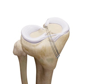 Meniscus Root Repair London, UK | Meniscal Root Tears Central London, UK