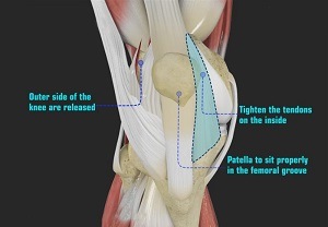 Patellofemoral Realignment Washington, DC | Patellofemoral Instability ...