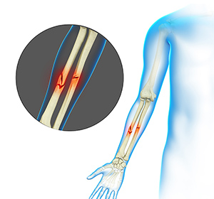 Adult Forearm Fracture Ventura, CA | Forearm Pain Treatment Oxnard, CA