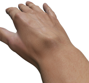 Ganglion Cyst Ventura, Camarillo, CA | Steroid Injection Oxnard, CA