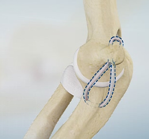 UCL Reconstruction Ventura, Camarillo, CA | UCL Injury Oxnard, CA