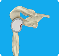 Shoulder Impingement Birmingham | Frozen Shoulder | Shoulder ...