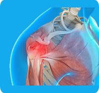 Shoulder Impingement Birmingham | Frozen Shoulder | Shoulder ...