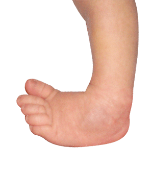 Congenital Deformity and Clubfoot | Mr. Shobhit Verma | Paediatric ...