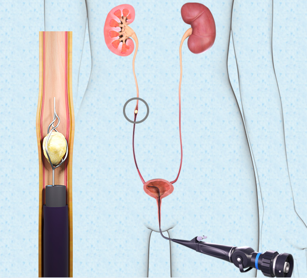Ureteroscopy Procedure Ureteroscopy Procedure