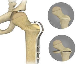 Derotational Distal Femoral Osteotomy Reno, Sparks, NV | Knee Arthritis ...