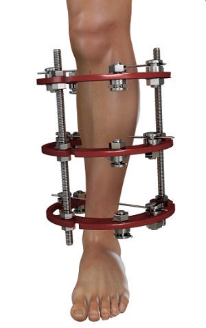 Limb Reconstruction | Brian Gilmer M.D., Knee & Sports Medicine ...