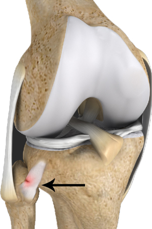 Proximal Tibiofibular Joint Proximal Tibiofibular Joint Injury