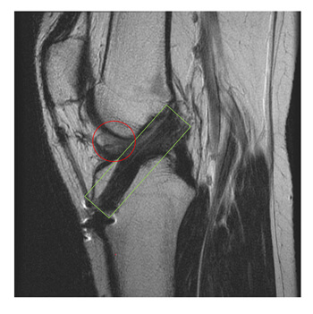 Cyclops Lesions | Brian Gilmer M.D., Knee & Sports Medicine Specialist ...
