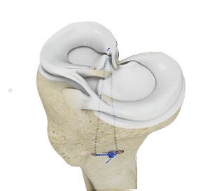 Knee Arthroscopy London | Knee Replacement Essex | Partial Knee Surgery UK