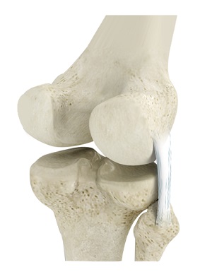 Posterolateral Corner (PLC) Injury Brentwood, London | PLC ...