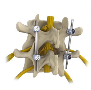 Neck Surgery West Valley City | Lumbar Fusion | Robotic Spine Surgery ...