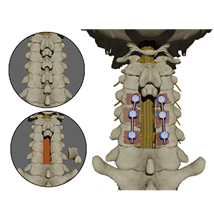 Neck Surgery West Valley City | Lumbar Fusion | Robotic Spine Surgery ...